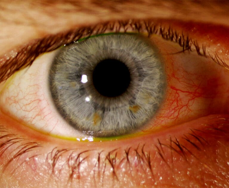 Episcleritis and Scleritis Diagnosis and Management - mivision