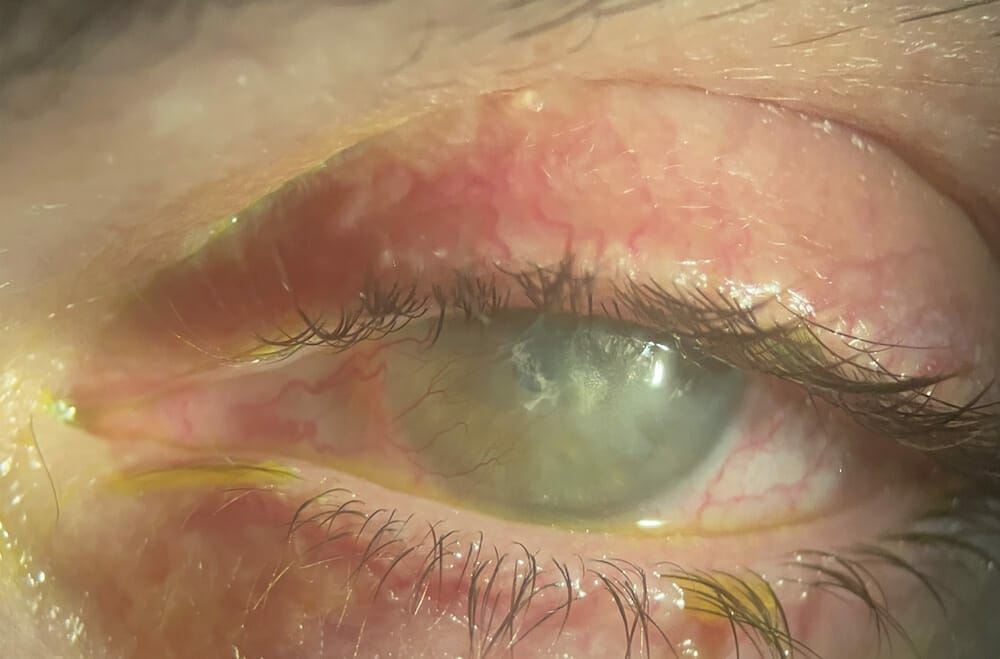 Amniotic Membrane: Managing an Anterior Eye Alkaline Burn - mivision