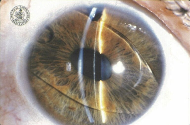 Refractive Correction with Phakic Intraocular Lenses - mivision