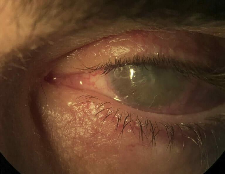 Amniotic Membrane: Managing an Anterior Eye Alkaline Burn - mivision