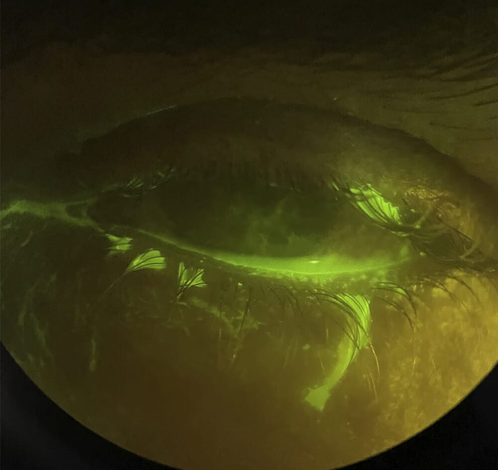 Amniotic Membrane: Managing an Anterior Eye Alkaline Burn - mivision