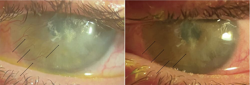 Amniotic Membrane: Managing an Anterior Eye Alkaline Burn - mivision