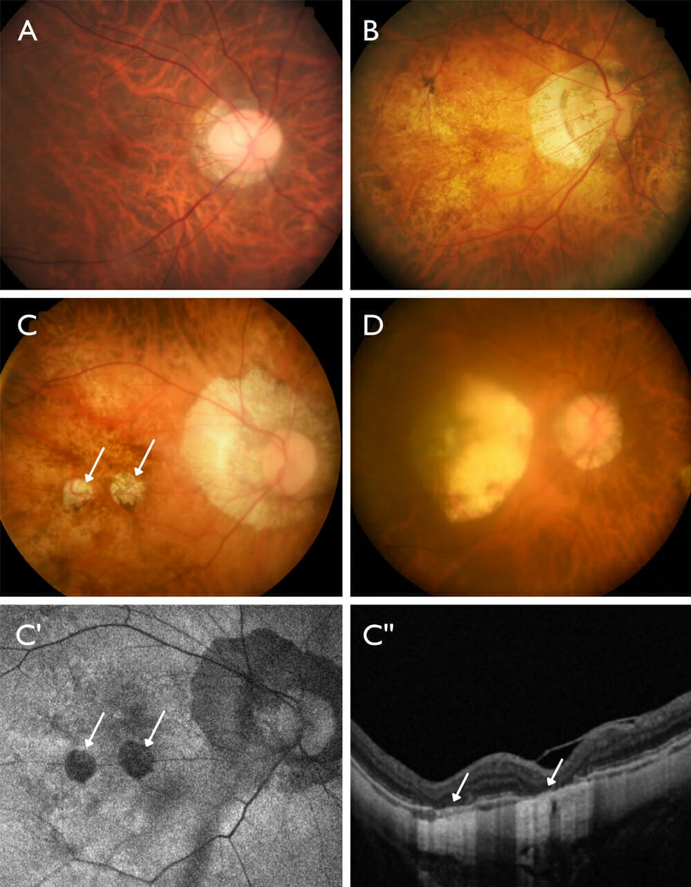 Myopic Maculopathy: A Practical Guide - mivision