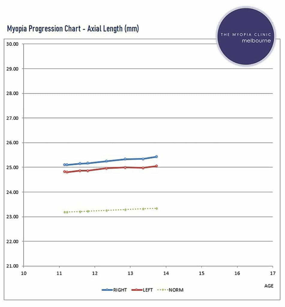 Myopia Management: Why Eye Length Matters - mivision