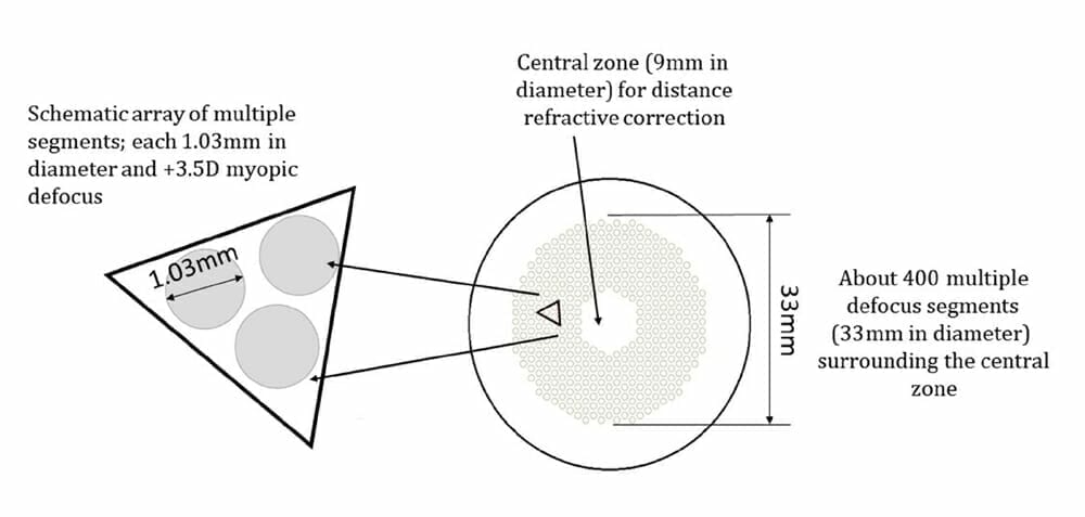 Myopia Controlling Spectacles: Next Generation Technology - mivision