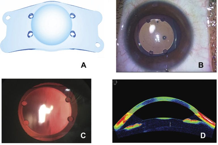 Refractive Correction with Phakic Intraocular Lenses - mivision