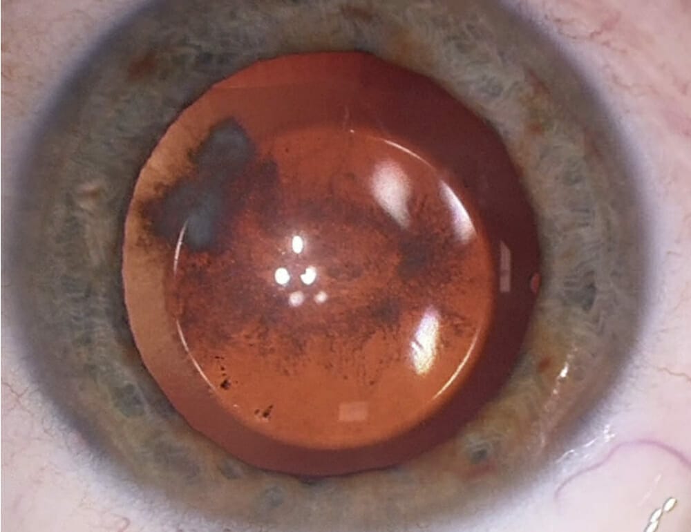 Refractive Correction with Phakic Intraocular Lenses - mivision