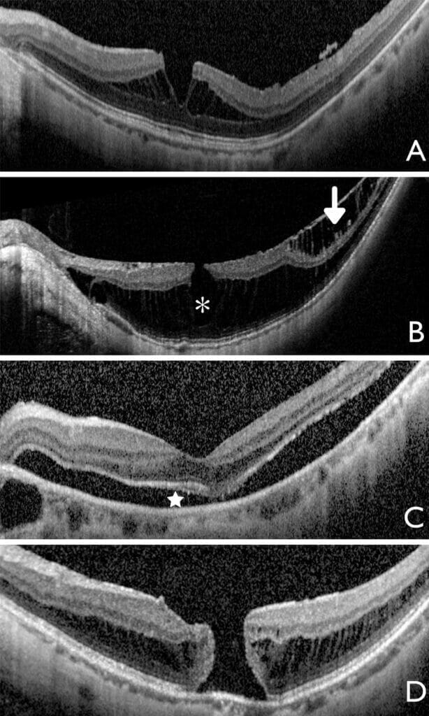 Myopic Maculopathy: A Practical Guide - mivision