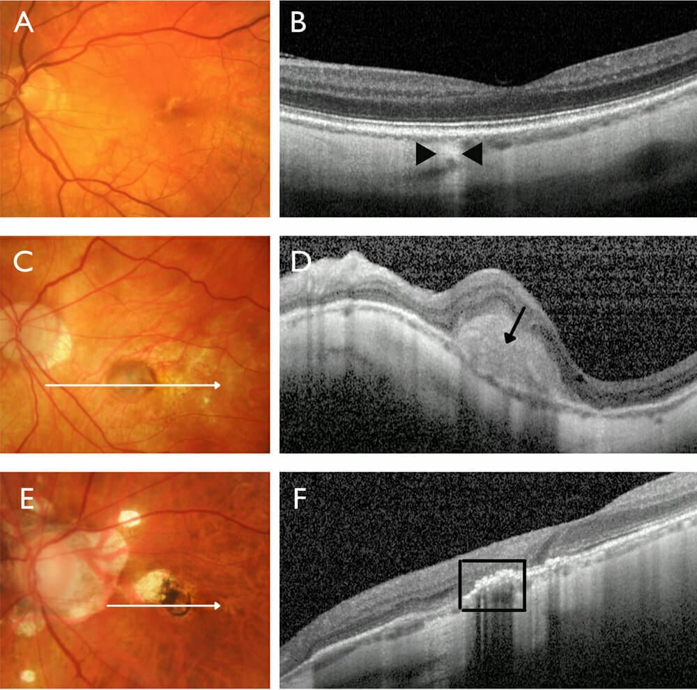 Myopic Maculopathy: A Practical Guide - mivision