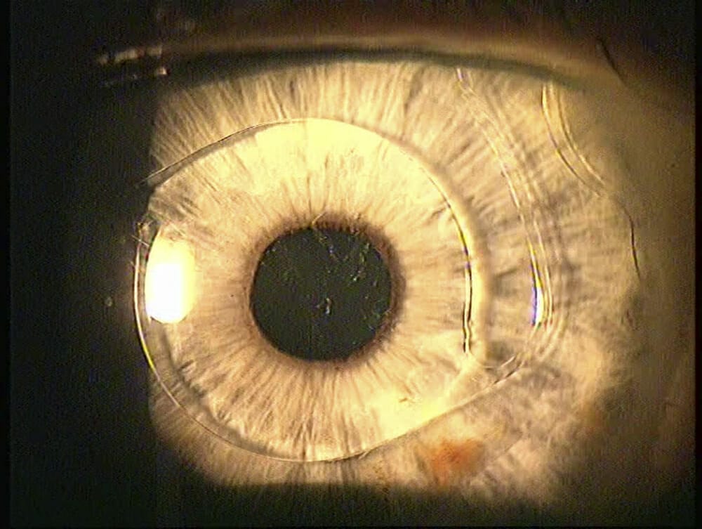 Refractive Correction with Phakic Intraocular Lenses - mivision