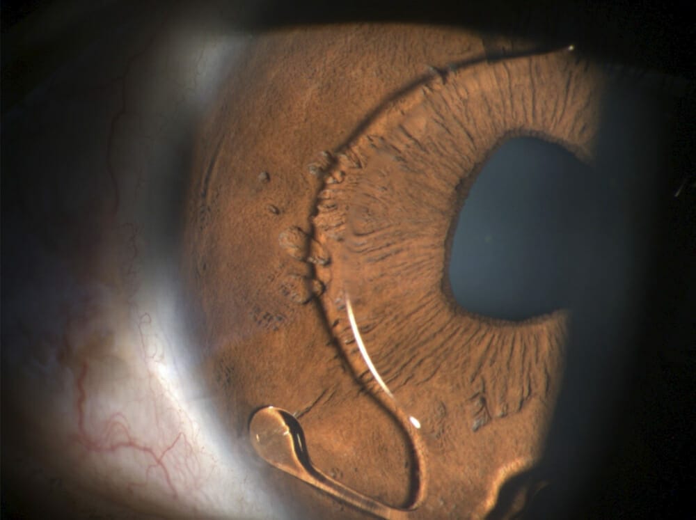 Refractive Correction with Phakic Intraocular Lenses - mivision