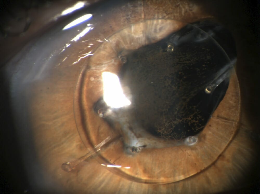 Refractive Correction with Phakic Intraocular Lenses - mivision
