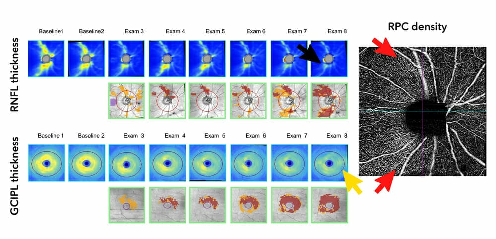 New Frontiers in Glaucoma Imaging - mivision