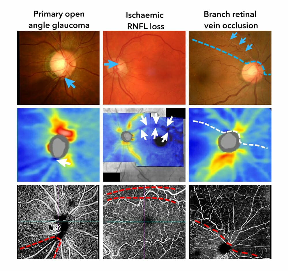 New Frontiers in Glaucoma Imaging - mivision