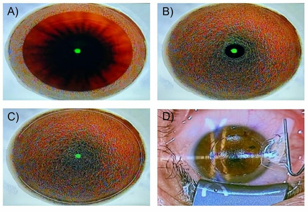 Laser Refractive Surgery Options - mivision