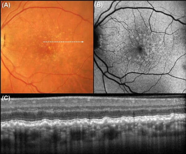 Drusen Phenotypes in AMD: The Prognostic Significance - mivision