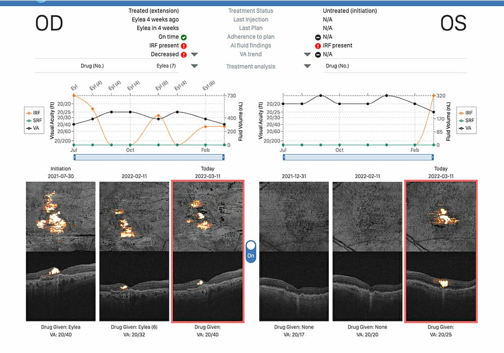 Paying it Forward: A Free AI Solution to Improve Outcomes for nAMD ...