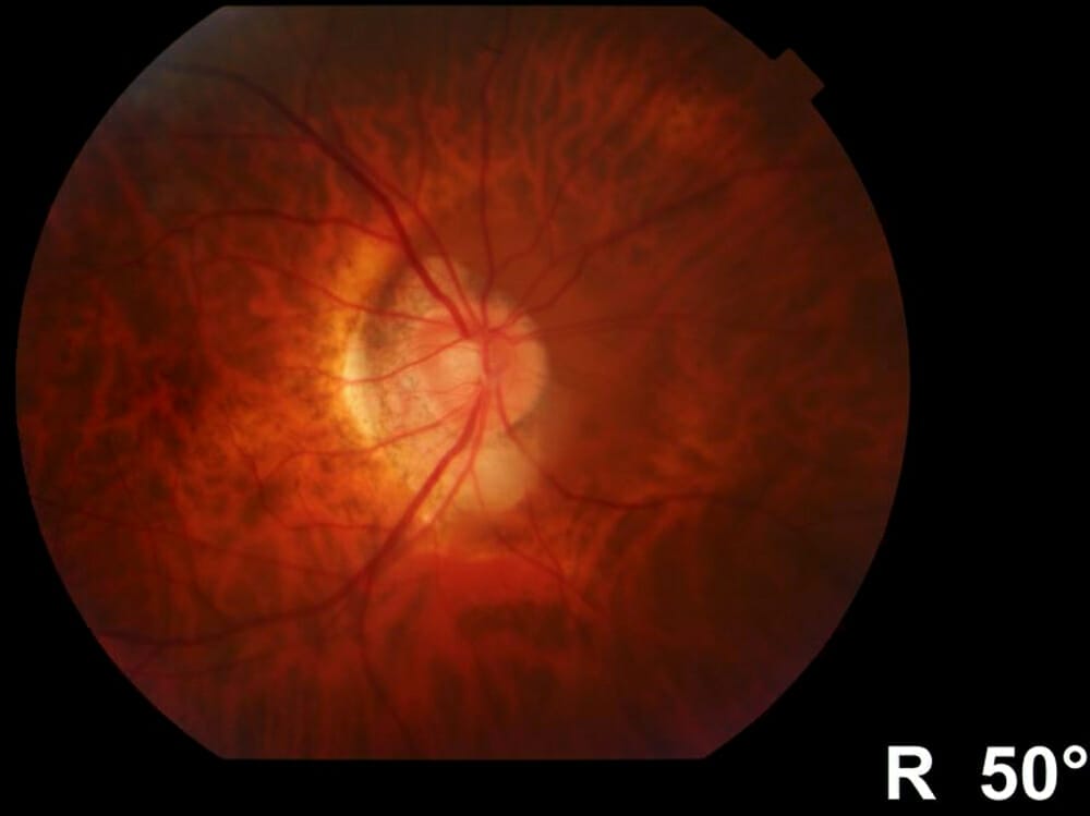 Premium Outcomes for Complex Cornea Patients - mivision