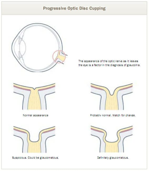 The Optometrist's Practitioner-Patient Manual: Glaucomatous Disc - mivision