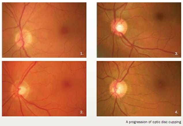 The Optometrist's Practitioner-Patient Manual: Glaucomatous Disc - mivision