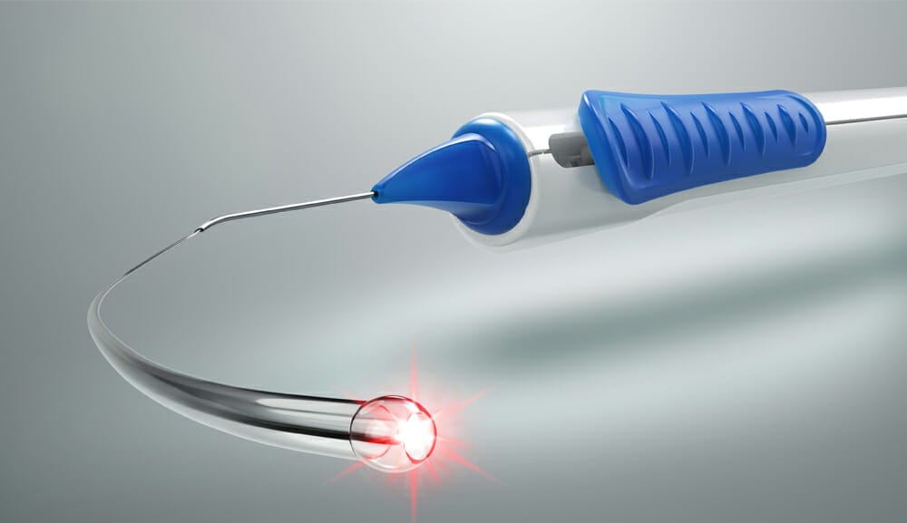 Next Gen Implant-free Glaucoma Device Launched - mivision