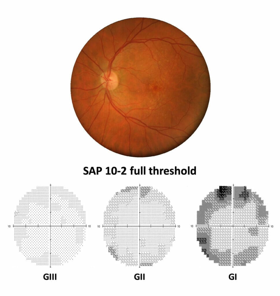 To Test or Not to Test? Visual Field Assessment in Early and ...