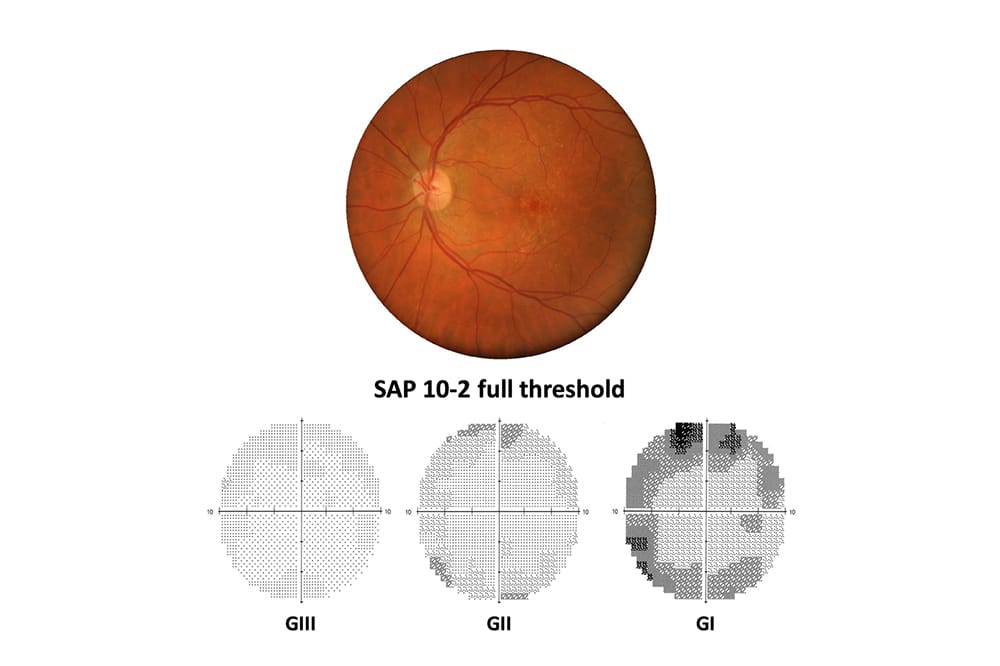 To Test or Not to Test? Visual Field Assessment in Early and ...