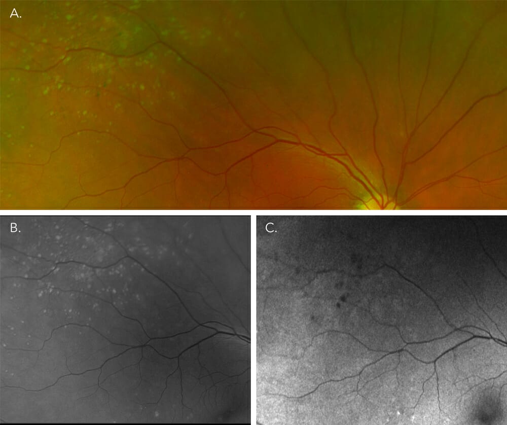 Shedding Light on the Far Side: Degenerative Peripheral Retinal Lesions ...