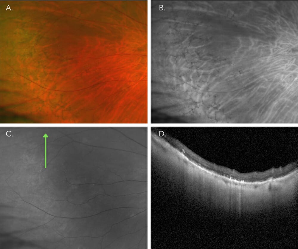 Shedding Light on the Far Side: Degenerative Peripheral Retinal Lesions ...