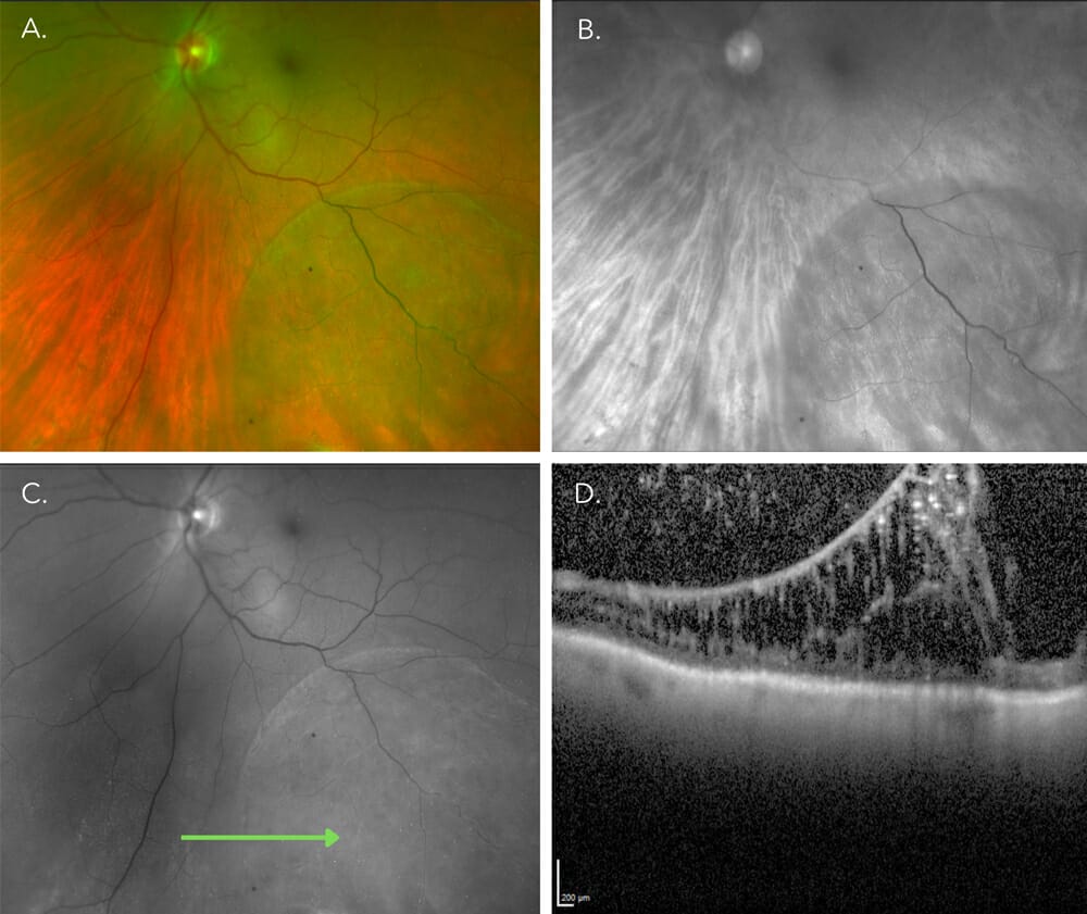 Shedding Light on the Far Side: Degenerative Peripheral Retinal Lesions ...