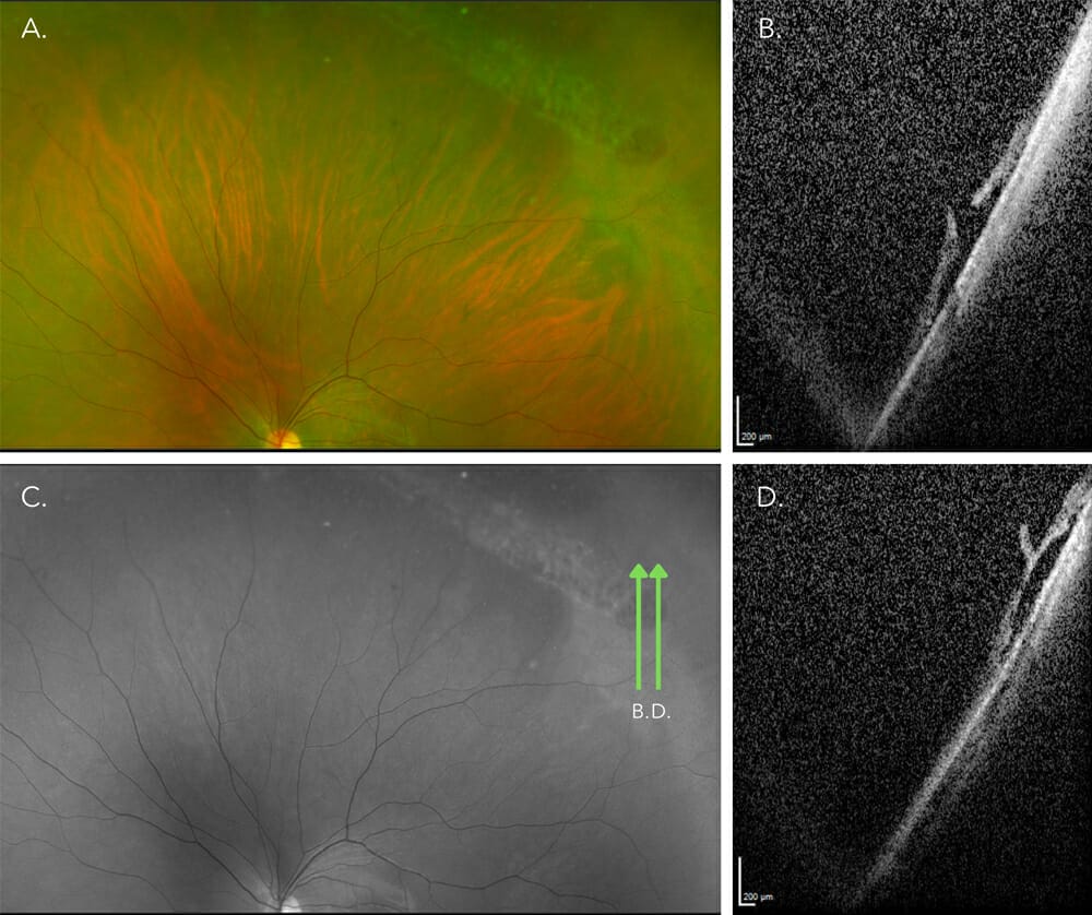 Shedding Light on the Far Side: Degenerative Peripheral Retinal Lesions ...