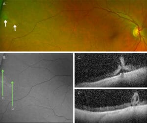 Shedding Light on the Far Side: Degenerative Peripheral Retinal Lesions ...