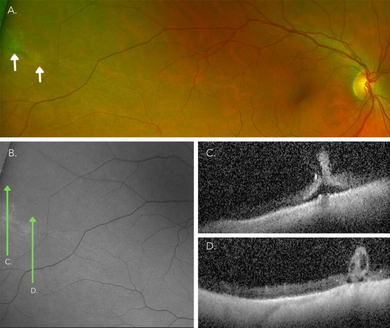 Shedding Light on the Far Side: Degenerative Peripheral Retinal Lesions ...