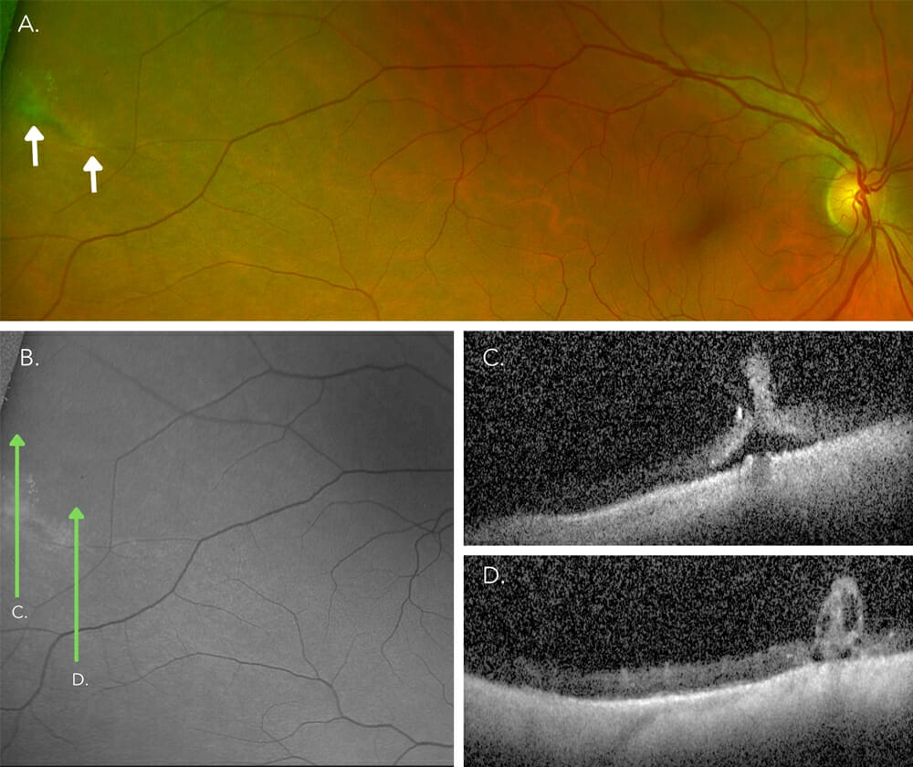 Shedding Light on the Far Side: Degenerative Peripheral Retinal Lesions ...