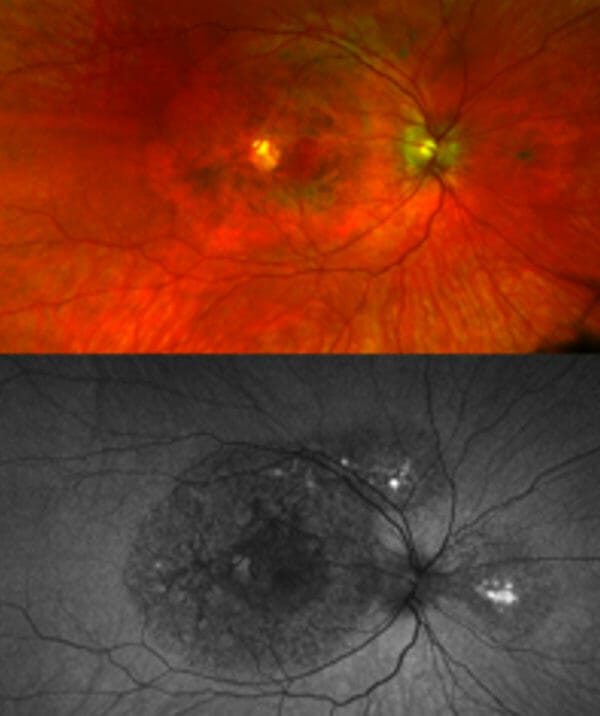 New Type of Macular Dystrophy Discovered - mivision