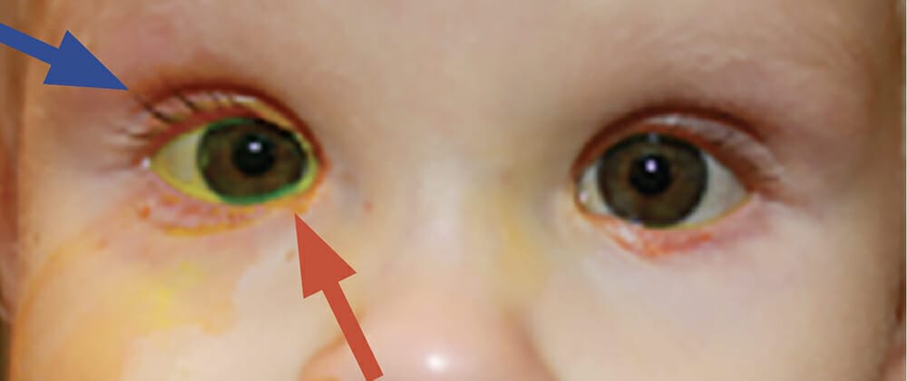 Managing Paediatric Eye Health with Ocular Plastics - mivision