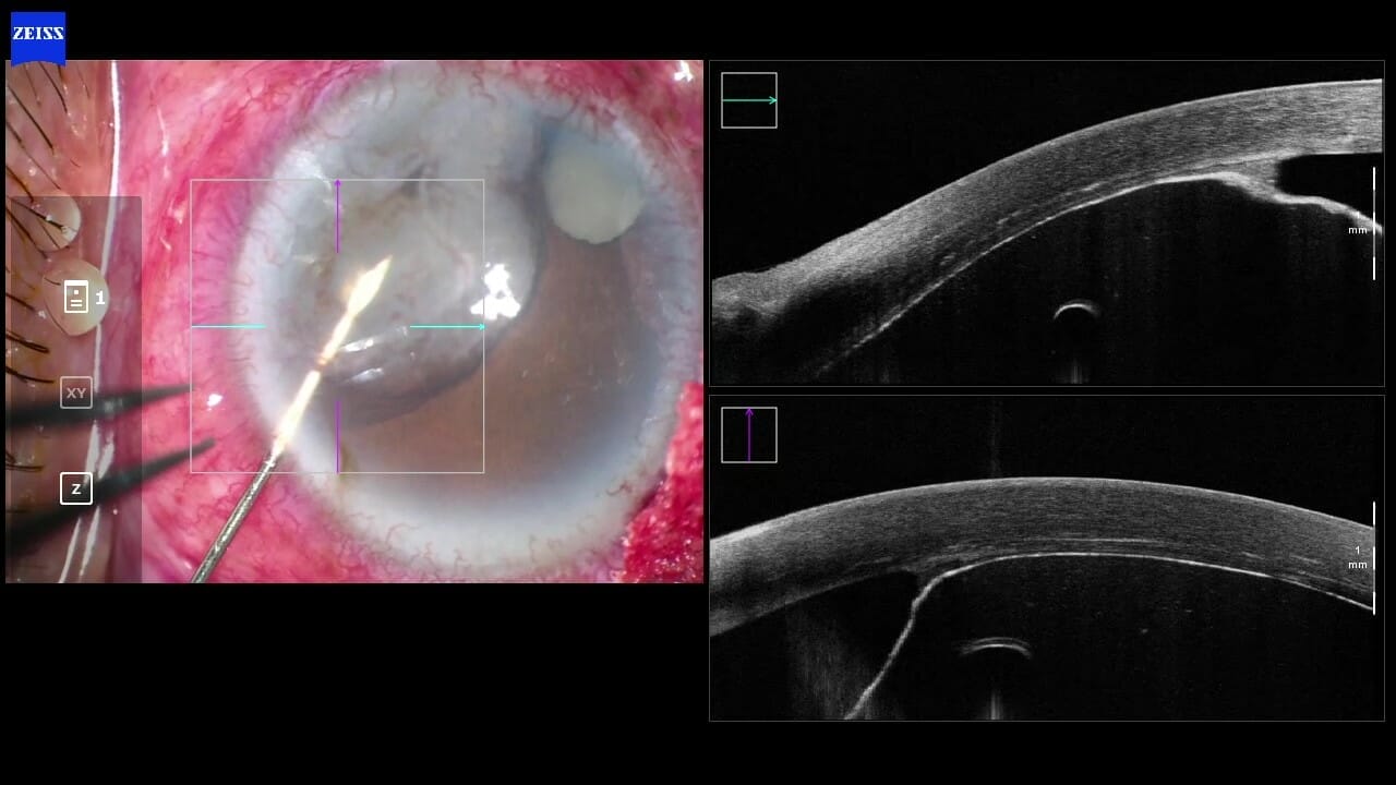 RANZCO Breakfast to Explore iOCT Applications - mivision