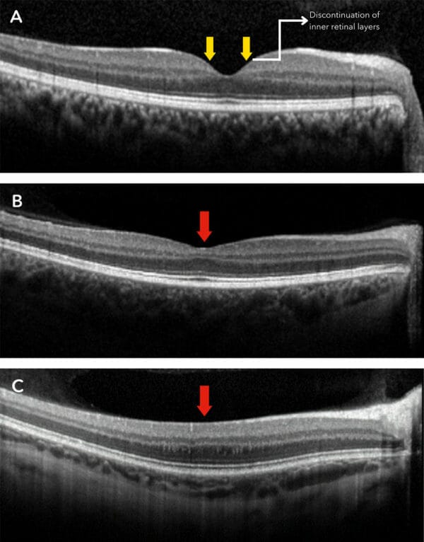 Foveal Hypoplasia Diagnosis With Oct And Clinical Management Mivision
