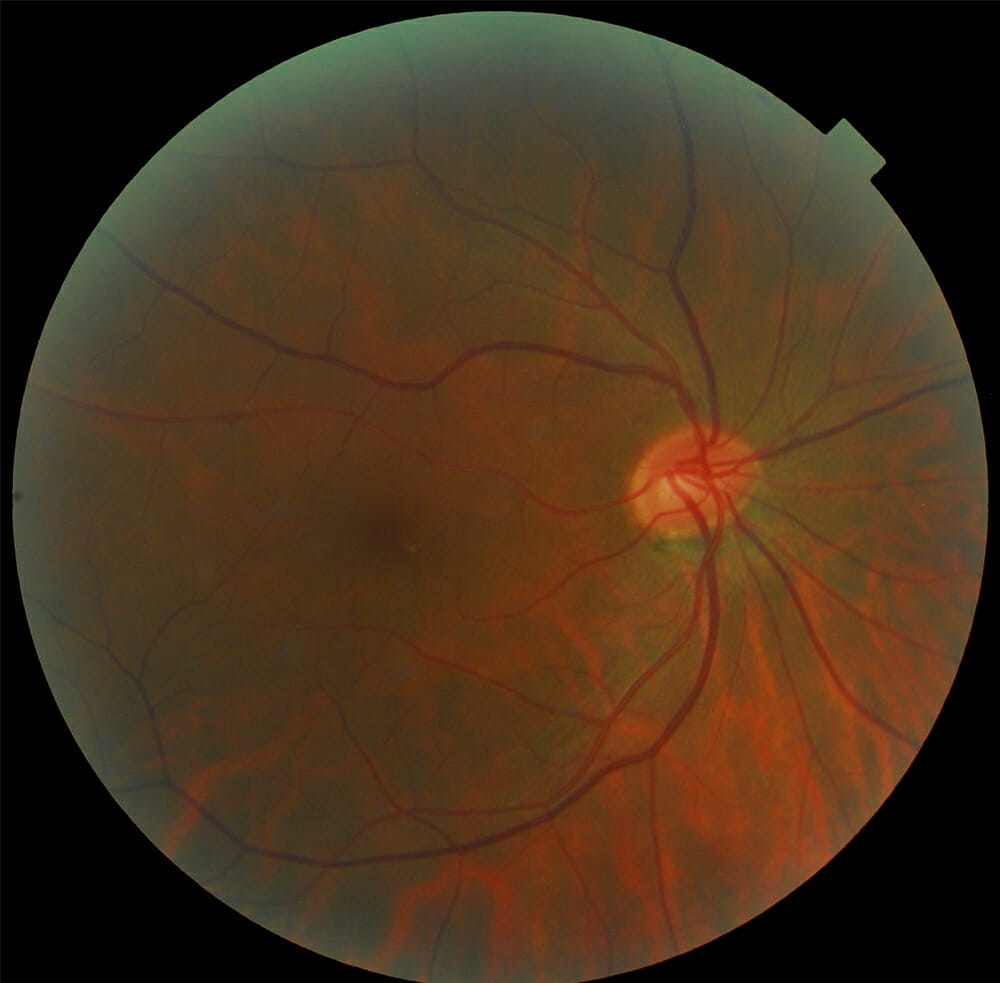 Toxic Optic Neuropathy: An Unspoken Cause of Vision Loss - mivision