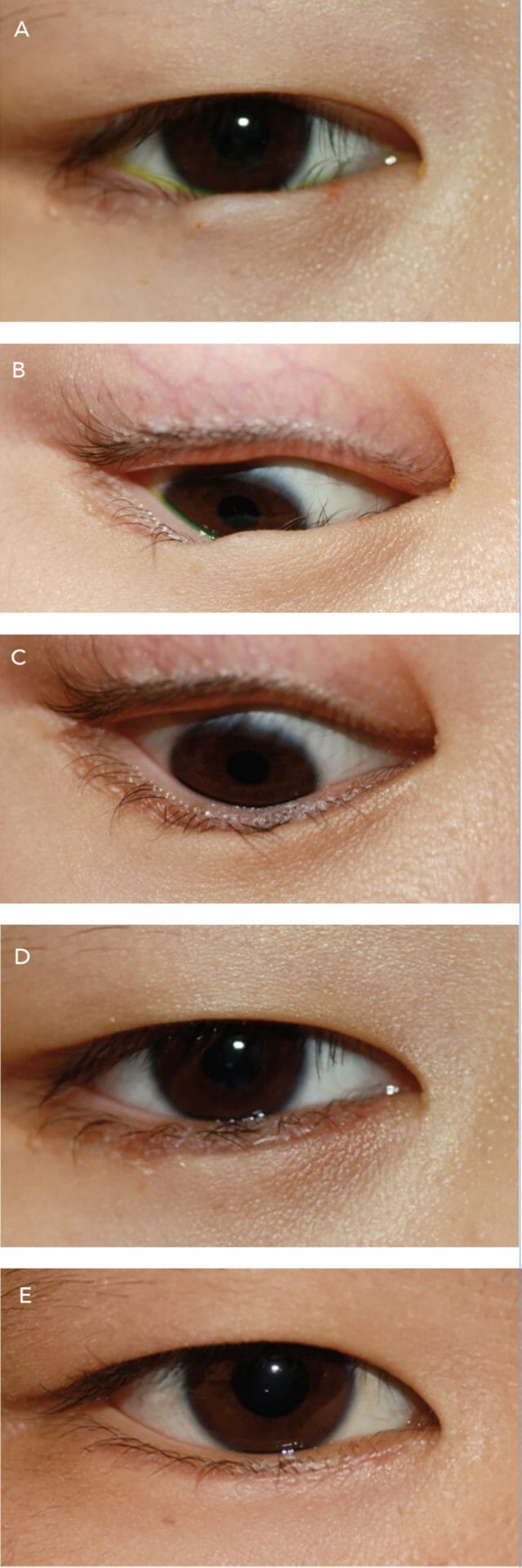 Managing Paediatric Eye Health with Ocular Plastics - mivision