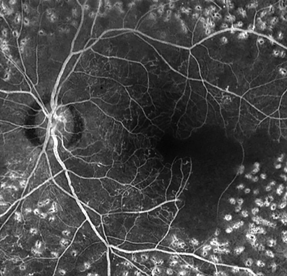Improving Ophthalmology Outcomes for Patients at RPAH - mivision