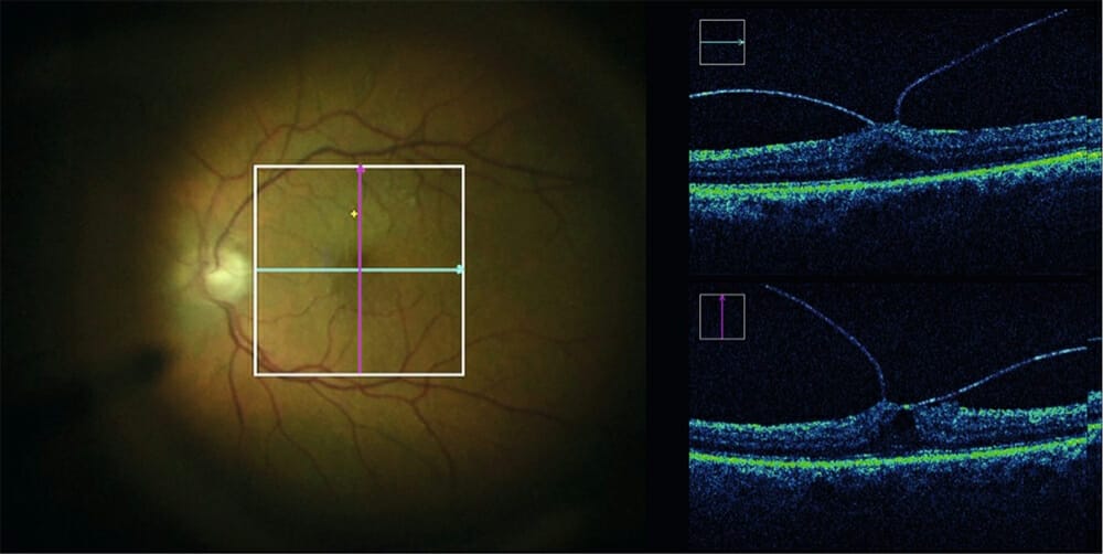 Improving Ophthalmology Outcomes for Patients at RPAH - mivision