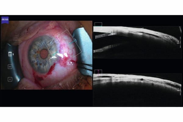 Zeiss Rescan intraoperative OCT - mivision