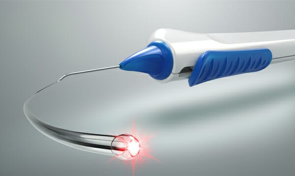 iTrack Advance Ab-interno Canaloplasty for Glaucoma - mivision