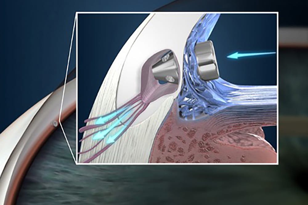 MIGS in 2022: What Optometrists Need to Know - mivision
