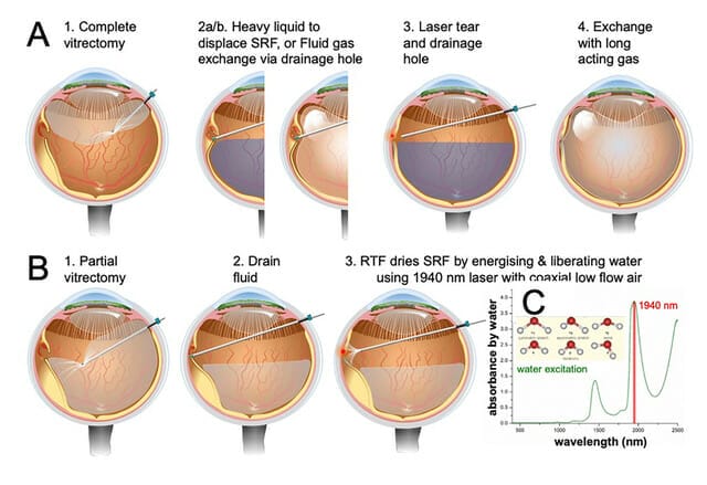 Advancing Options in Retinal Detachment Repair - mivision