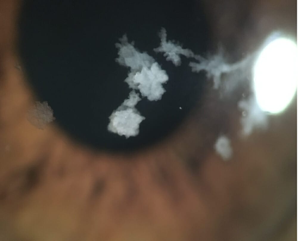 Identifying Corneal Dystrophies and Degenerations - mivision