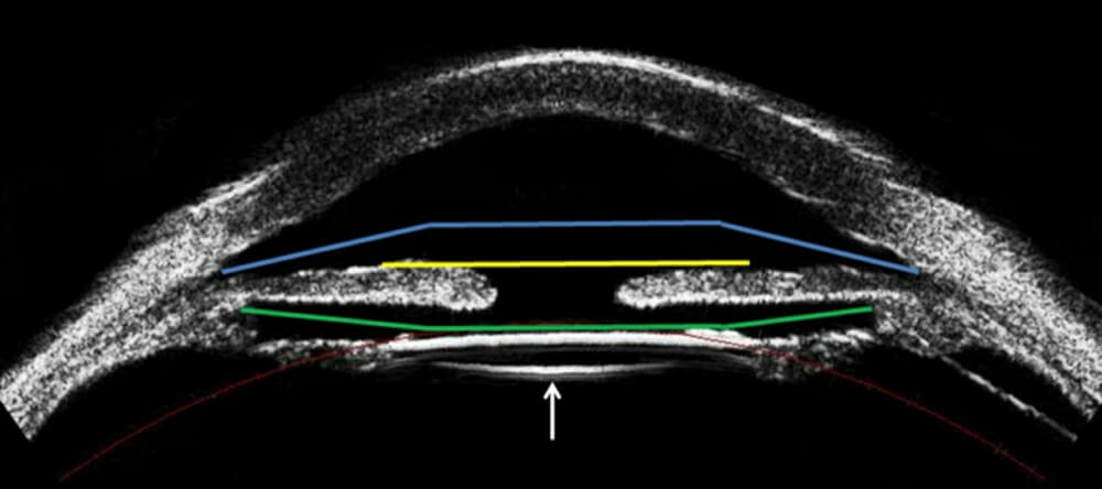 Cataract Surgery: New and Emerging Technology - mivision