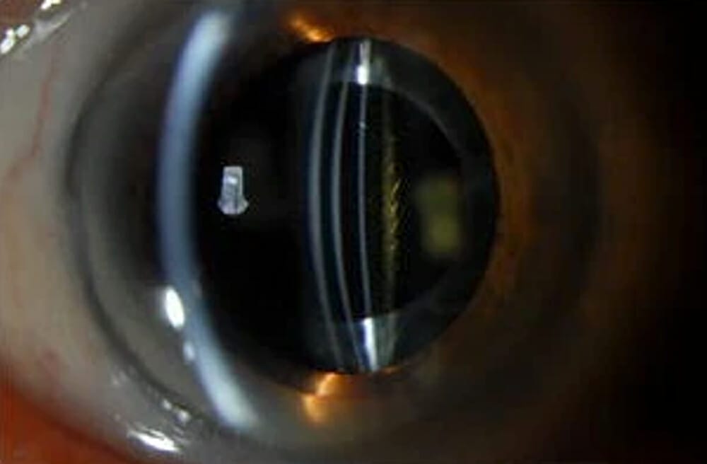 Cataract Surgery: New and Emerging Technology - mivision