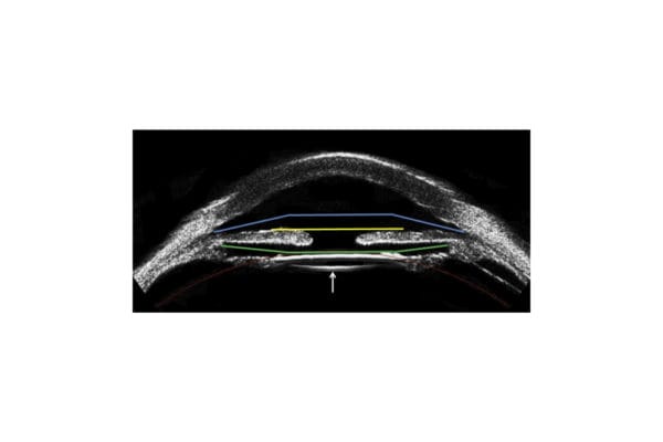 Cataract Surgery: New and Emerging Technology - mivision